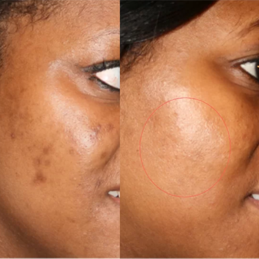 Perfect Derma Peel | Med Spa in Greensboro