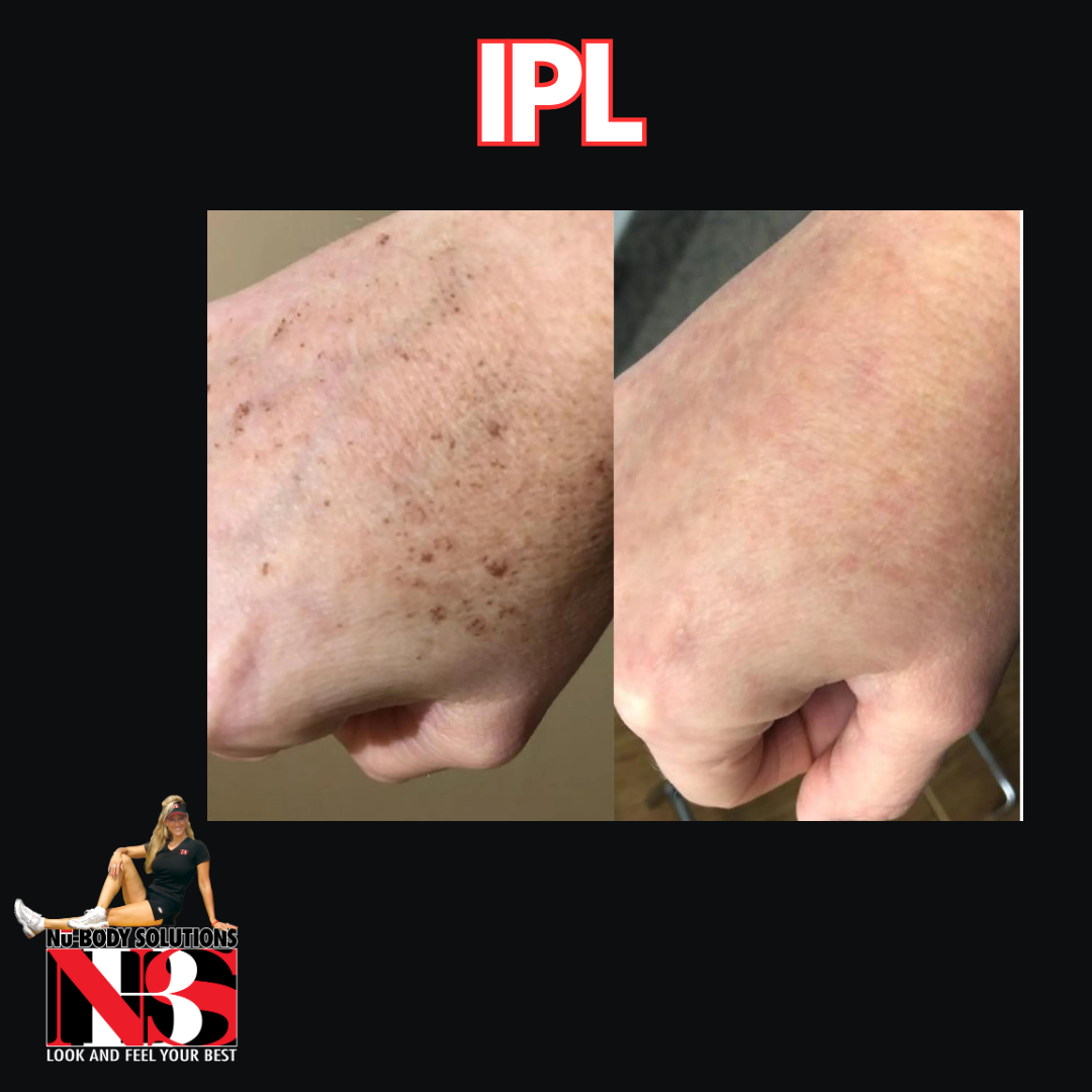 IPL Treatments