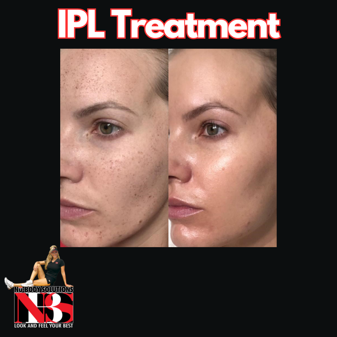 IPL Treatments