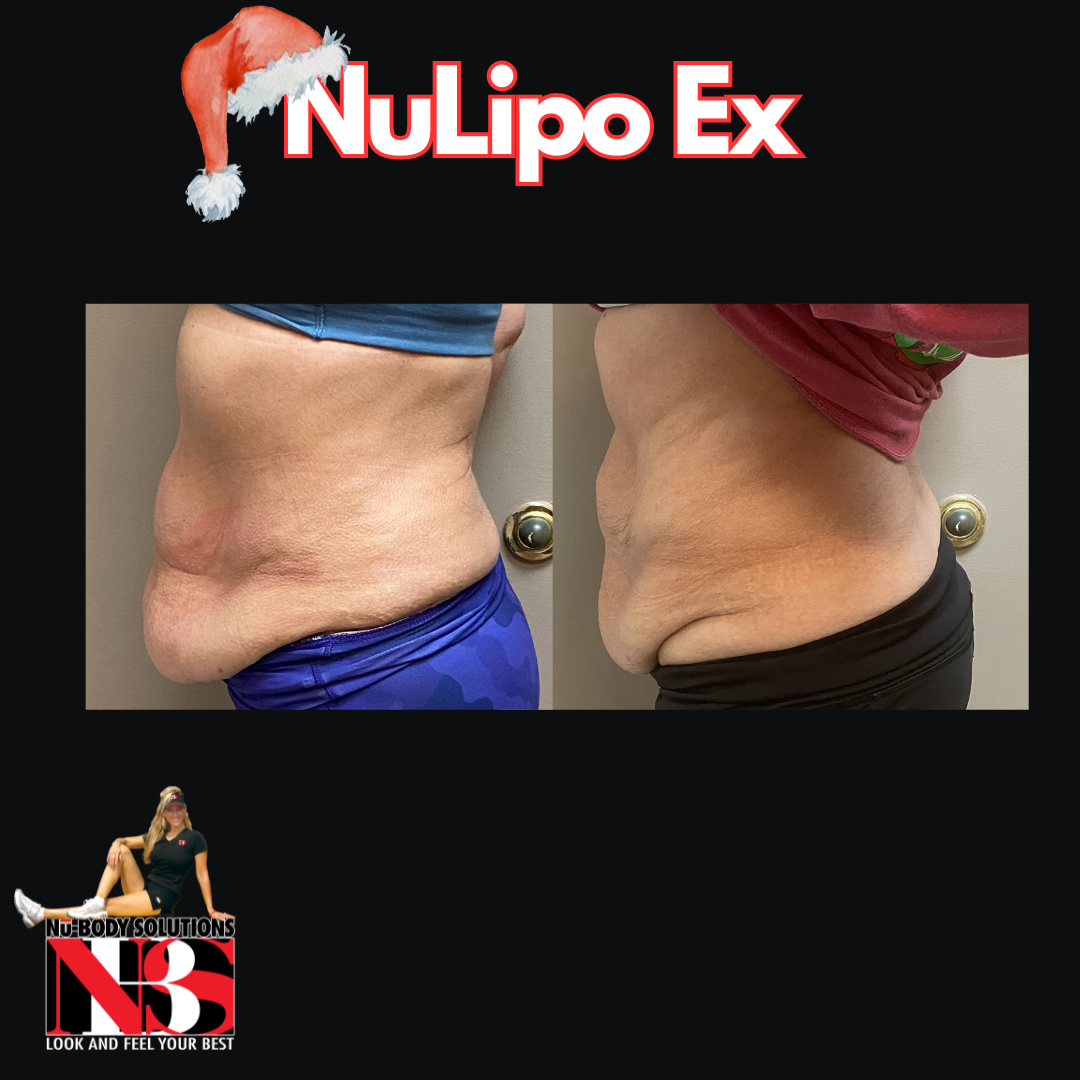 NuLipo Ex Advanced